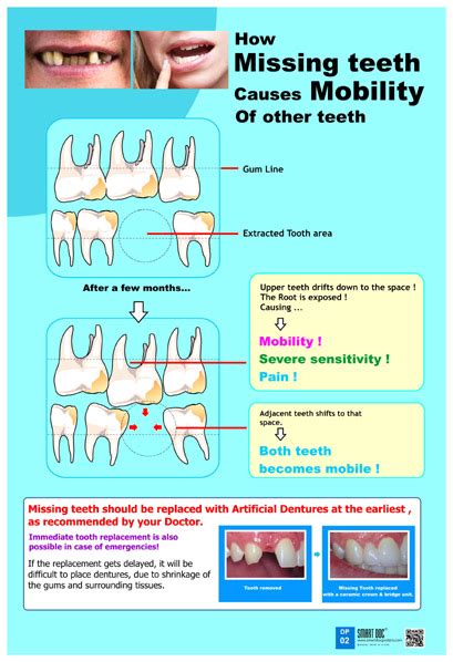 How Missing Teeth Causes Mobility Of Other Teeth Eng Dp 02 Smart