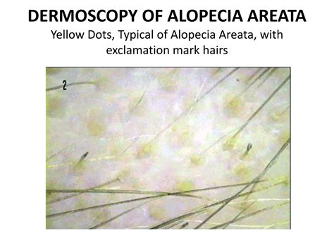 Everything You Need To Know About Alopecia Areata PDF