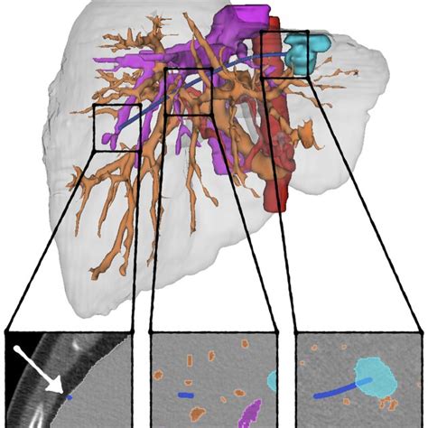 A Liver Environment From The Dataset Showing The Segmented Hepatic