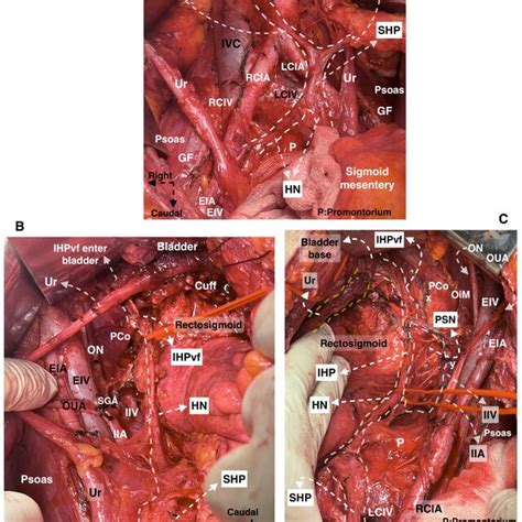 Pelvic Autonomic Nerve Plexus Selective Nerve Sparing During Type C2