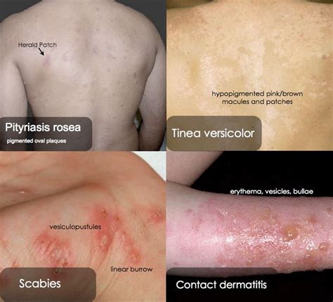 Pityriasis Rosea Vs Tinea Versicolor Good Captions