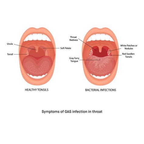 What Is Streptococcus A Strep A How Does The Strep A Test Kit Work Vitrosens Biotechnology
