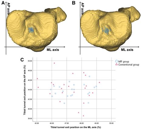 Accuracy Of Femoral Tunnel Localization With Mixed Reality Technologyassisted Single Bundle Acl