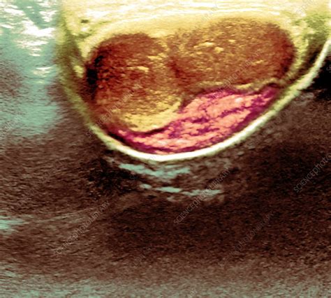 Plaque In A Patient With Peyronie Disease Ultrasound Scan Stock