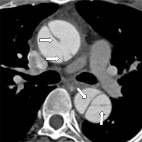 Multiple Line Type Of The Intimal Flap On An Axial Ct Image