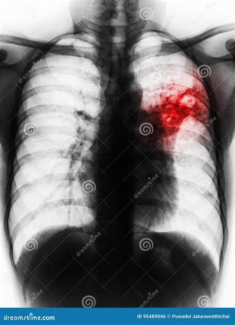 Tuberculose Pulmonaa O Alveolar Da Mostra Do Raio X De Caixa Do Filme