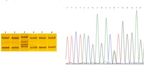 Mutation Analysis In Exons 22 And 24 Of Scn4a Gene In Iranian Patients