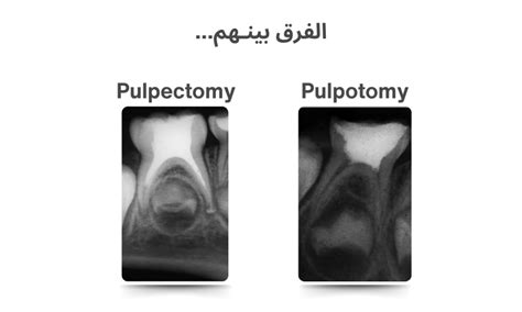 Pulpotomy Vs Pulpectomy Galaxy Digital Dentistry
