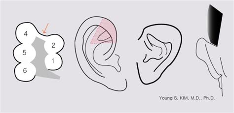 보나성형외과 👂 수축귀 치료경과 궁금해요 귀상부가 접힌 형태인 수축귀 수축귀에는 여러 모양의