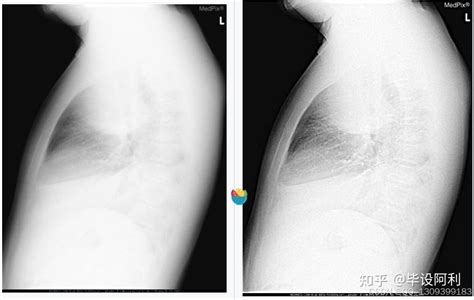 医学图像处理 X射线图像增强 对比度限制自适应直方图均衡化（clahe）、非锐化掩模（um）和高频强调滤波（hef） 知乎