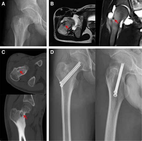 Preoperative And Postoperative Imaging Features Of Femoral Neck Oo A