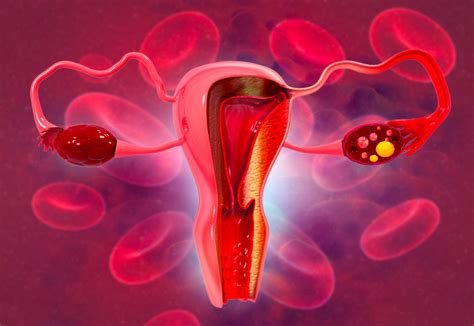 Polyp T Cung C Nguy Hi M Kh Ng V M I Nguy C N Bi T