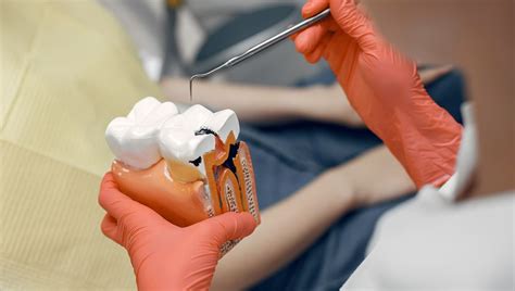 Cómo saber si tengo caries Estos son los síntomas