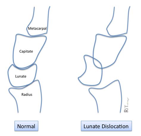 RiT Radiology Lunate Dislocation