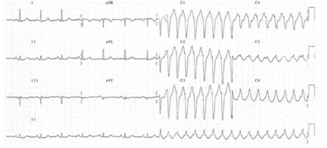 Narrow Complex Tachycardias The Lay Medical Man