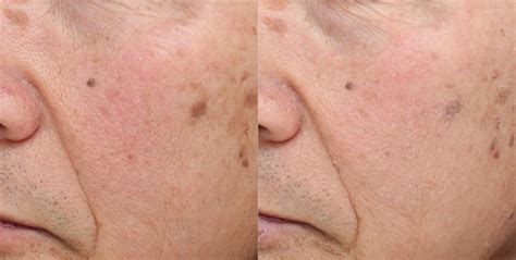 Clearsilk Before And After Photo Gallery Medford Oregon Pure Spa