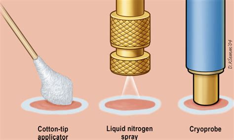 Cryosurgery Uses In Dermatology Dermatology Games