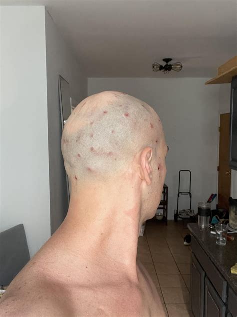 Could They Also Be Ingrown Hair Bumps One Thing I Found To Help Is