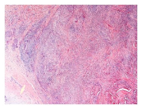 Massive Fibrosis In A Storiform Pattern Areas Of Accumulation Of
