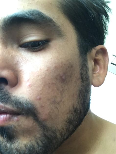 Do I Have Fungal Acne Rfungalacne