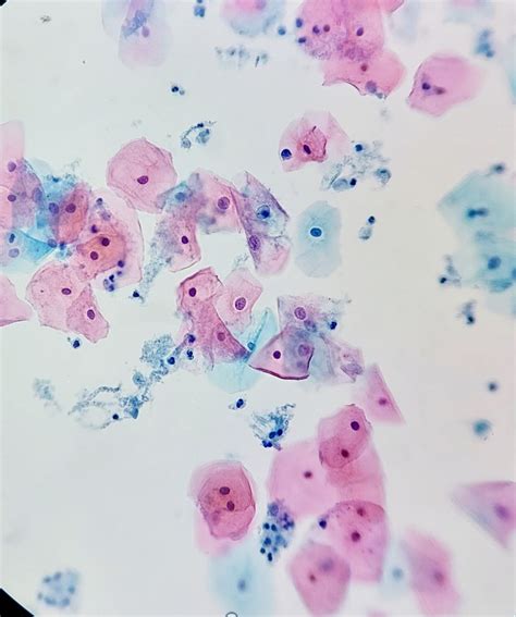 Sara Salih On Linkedin Thinprep Pap Smear 22 Comments