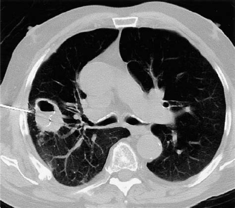 Control CT Scan Immediately Download Scientific Diagram