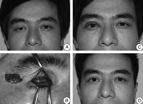 Blepharoptosis Correction By Excision Of Levator Muscle And