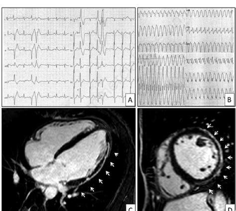 Life Threatening Ventricular Arrhythmias In An Athlete With