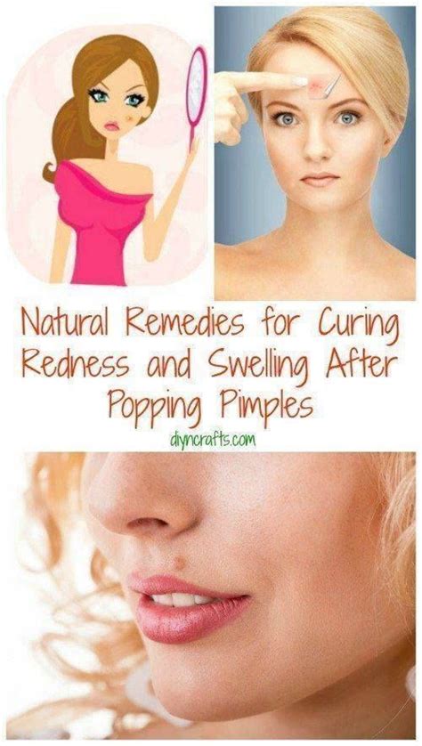 The Right Way To Pop A Pimple And The Best Way Acne Redness How To Get Rid Of Acne Pimples