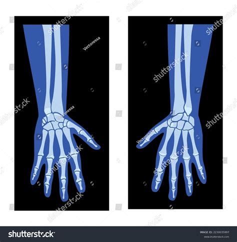 X Ray Hands Radius Ulna Skeleton Human Stock Vector Royalty Free