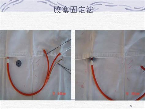 【ppt】三腔二囊管的应用及护理 文库