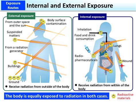 Describe The Differences Between External And Internal Radiation Therapy