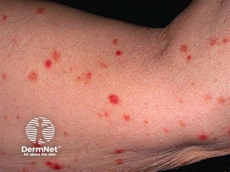 Guttate Psoriasis Images