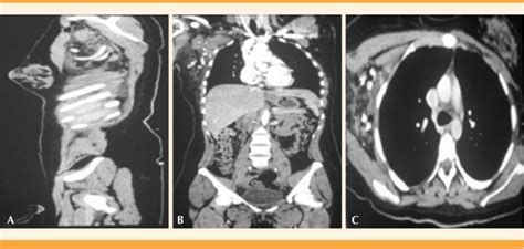 Tomografía en cortes coronal A y axial B y C Conglomerado Download Scientific Diagram