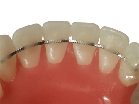 SCFR 845 Self Cleansable Fixed Retainer V LOOP OR LINGUAL ARCH 3X3 EODO