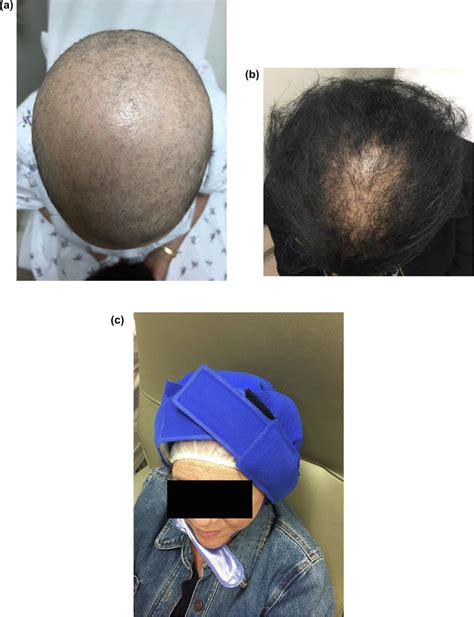 A Diffuse Nonscarring Alopecia Of The Scalp As A Result Of Taxane