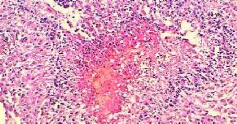 Microscopic Appearance Focal Areas Of Necrosis Hematoxylin And Eosin
