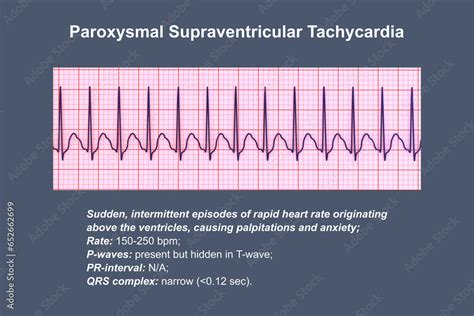 ECG In Supraventricular Tachycardia 3D Illustration Stock Illustration