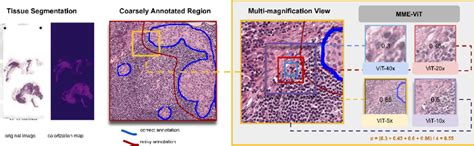 Robust Tumor Detection By Averaging Over Predictions From Vision