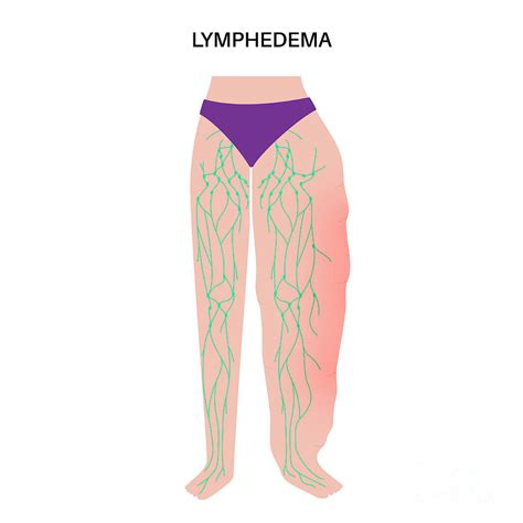 Lymphoedema Leg Swelling 2 Photograph By Science Photo Library