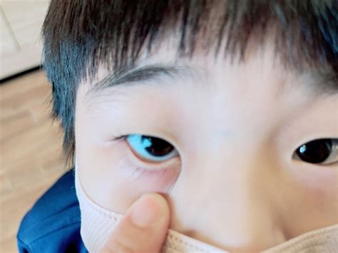 아기 물놀이 후 눈 충혈 눈꼽끼는 바이러스성 결막염 유행성 결막염 증상 네이버 블로그