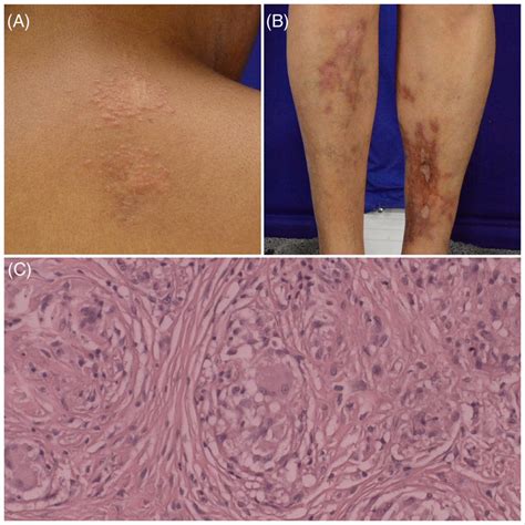 A Yellow‐to‐orange Papules Become Confluent To An Infiltrated Plaque