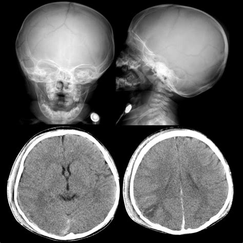 Pediatric Subgaleal Hematoma Pediatric Radiology Reference Article