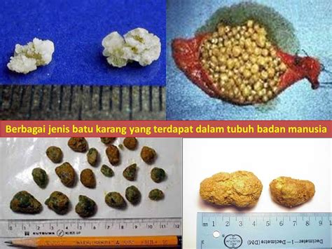 Batu Dalam Hempedu The Silent Killer ~ Healthy Life