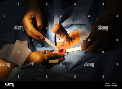 Phalloplasty Surgery Cost What Is A Phalloplasty Mjyun