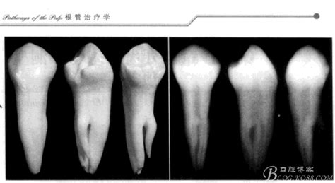 下颌第一前磨牙的根管治疗张昌龙 张昌龙的博客 KQ88口腔博客