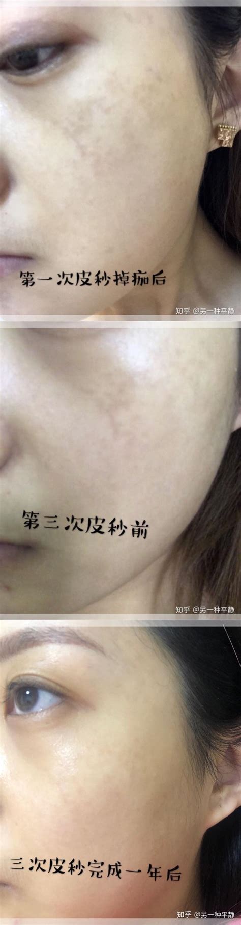 皮秒祛斑过程记录（完结） 知乎