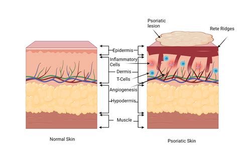 Normal Skin And Psoriatic Skin Biorender Science Templates