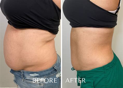 Liquid Lipo Pcdc Minimally Invasive Fat Dissolving Procedure