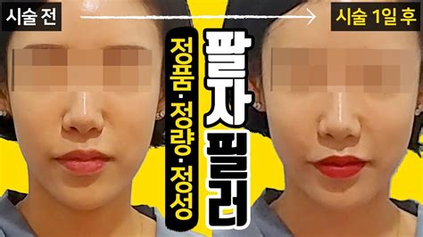 팔자주름 앞광대필러 시술 영상 톡스앤필 서울대입구점 서울대입구역 피부과 필러 Youtube